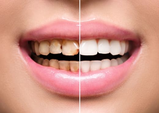 Teeth Whitening | Sky Creek Dental | Keller, Tx